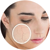 Dry Skin – Cheek and Chin